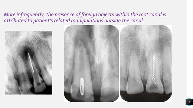 Endodontic instrument fracture and thier management by dr.maryam salman ...