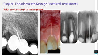 Endodontic instrument fracture and thier management by dr.maryam salman ...