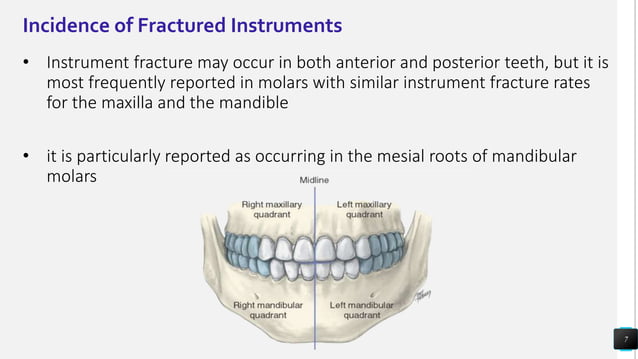Endodontic instrument fracture and thier management by dr.maryam salman ...