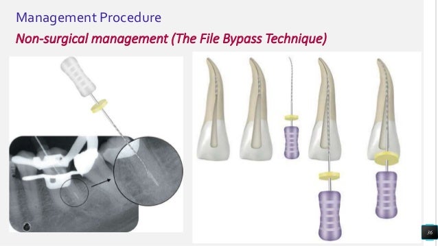 Endodontic instrument fracture and thier management by dr.maryam salm…