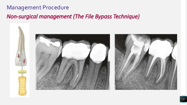 Endodontic instrument fracture and thier management by dr.maryam salm…