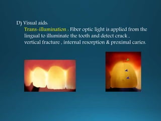 Endodontic instruments 1 | PPTX