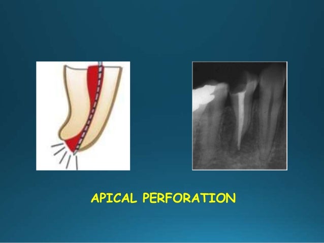 Endodontic instruments 2