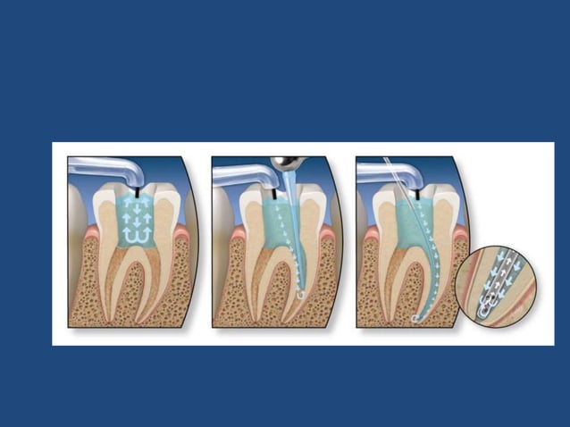 Endodontic irrigants pres | PPT