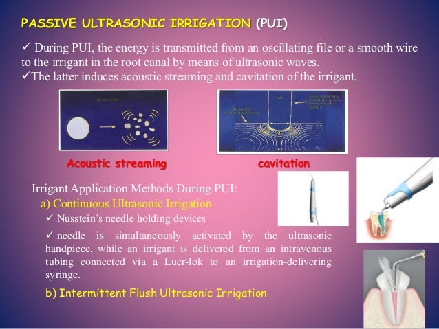 Endodontic irrigating devises