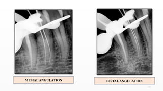 ENDODONTIC MANAGEMENT OF VERTUCCI –TYPE IV MANDIBULAR.pptx