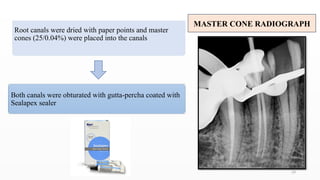 ENDODONTIC MANAGEMENT OF VERTUCCI –TYPE IV MANDIBULAR.pptx