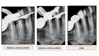 ENDODONTIC MANAGEMENT OF VERTUCCI –TYPE IV MANDIBULAR.pptx