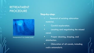 ENDODONTIC MISHAPS: NAVIGATING THE UNEXPECTED | PPTX