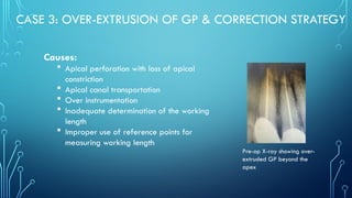 ENDODONTIC MISHAPS: NAVIGATING THE UNEXPECTED | PPTX