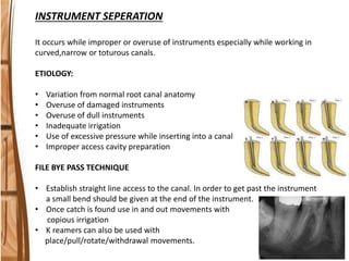 Endodontic mishaps/PROCEDURAL ACCIDENTS | PPTX
