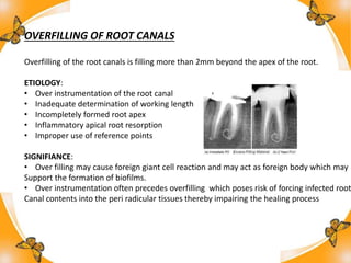 Endodontic mishaps/PROCEDURAL ACCIDENTS | PPTX