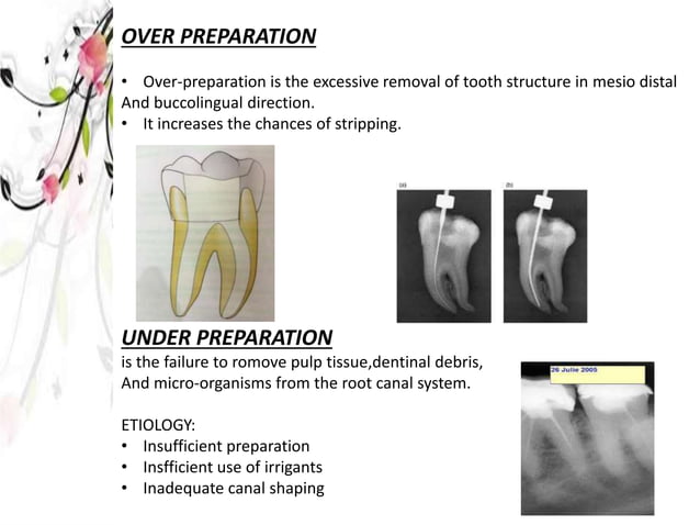 Endodontic mishaps/PROCEDURAL ACCIDENTS