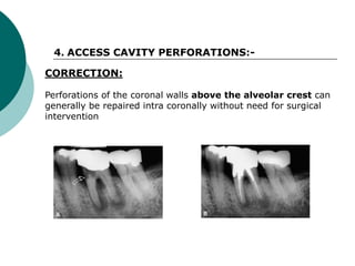 ENDODONTIC MISHAPS.ppt