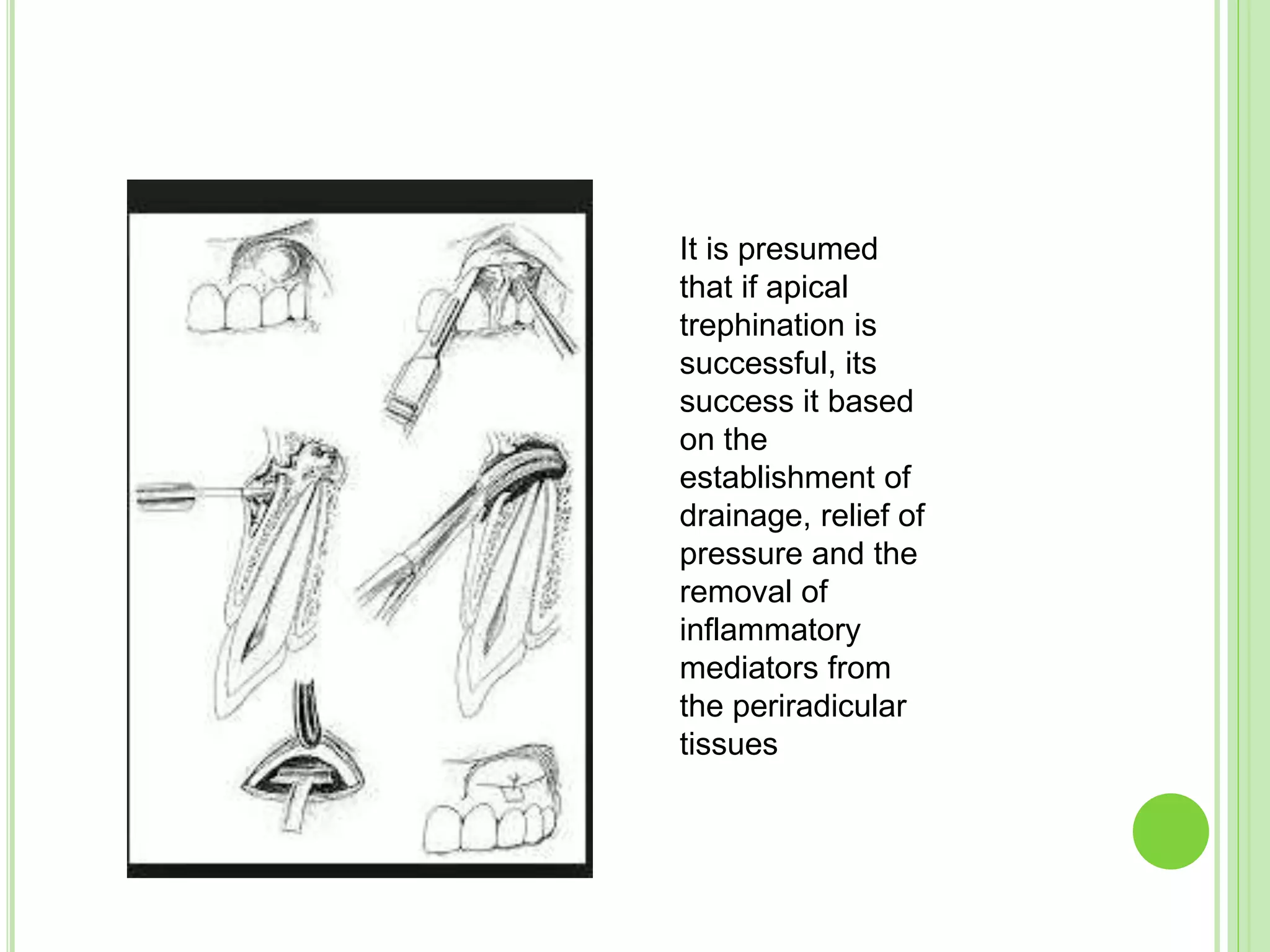 Endodontic pain management | PPTX