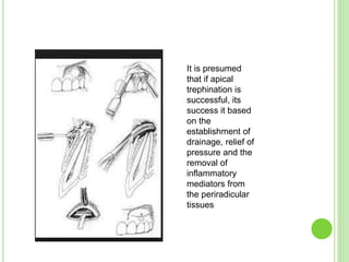 Endodontic pain management | PPTX