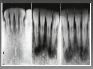 Endodontic radiograph | PPT