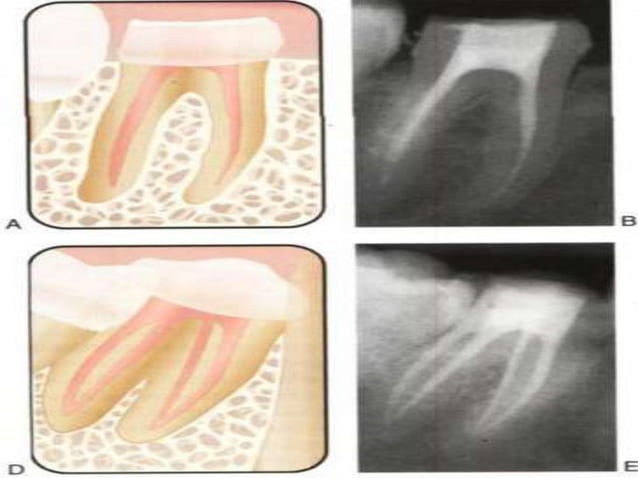 Endodontic radiograph | PPT