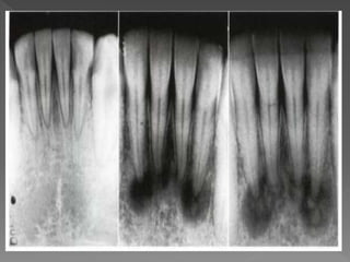 Endodontic radiograph | PPT