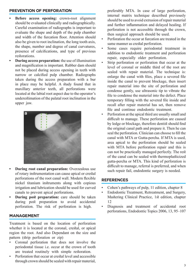 Endodontic Root Perforation: Causes, Identification, and Management ...