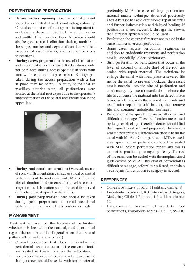Endodontic Root Perforation: Causes, Identification, and Management L…