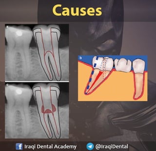 Endodontic Root Perforation: Causes, Identification, and Management ...