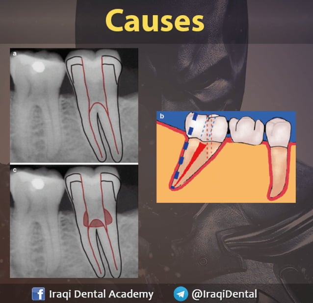 Endodontic Root Perforation Causes Identification And Management Presentation