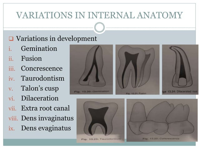 Anatomy of pulp chamber | PPTX | Dental Health | Diseases and Conditions