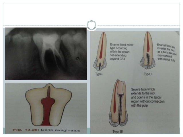 Anatomy of pulp chamber | PPTX | Dental Health | Diseases and Conditions