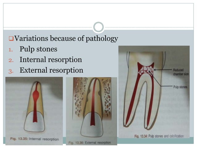 Anatomy of pulp chamber | PPTX | Dental Health | Diseases and Conditions