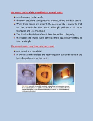 Access opening of second and third molars | DOCX