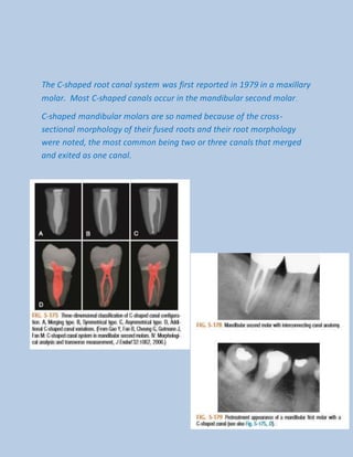 Access opening of second and third molars | DOCX