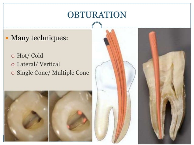 Endodontics - An Introduction | PPTX | Dental Health | Diseases and ...