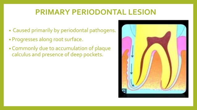 Endodontics periodontal lesions | PPTX | Dental Health | Diseases and ...