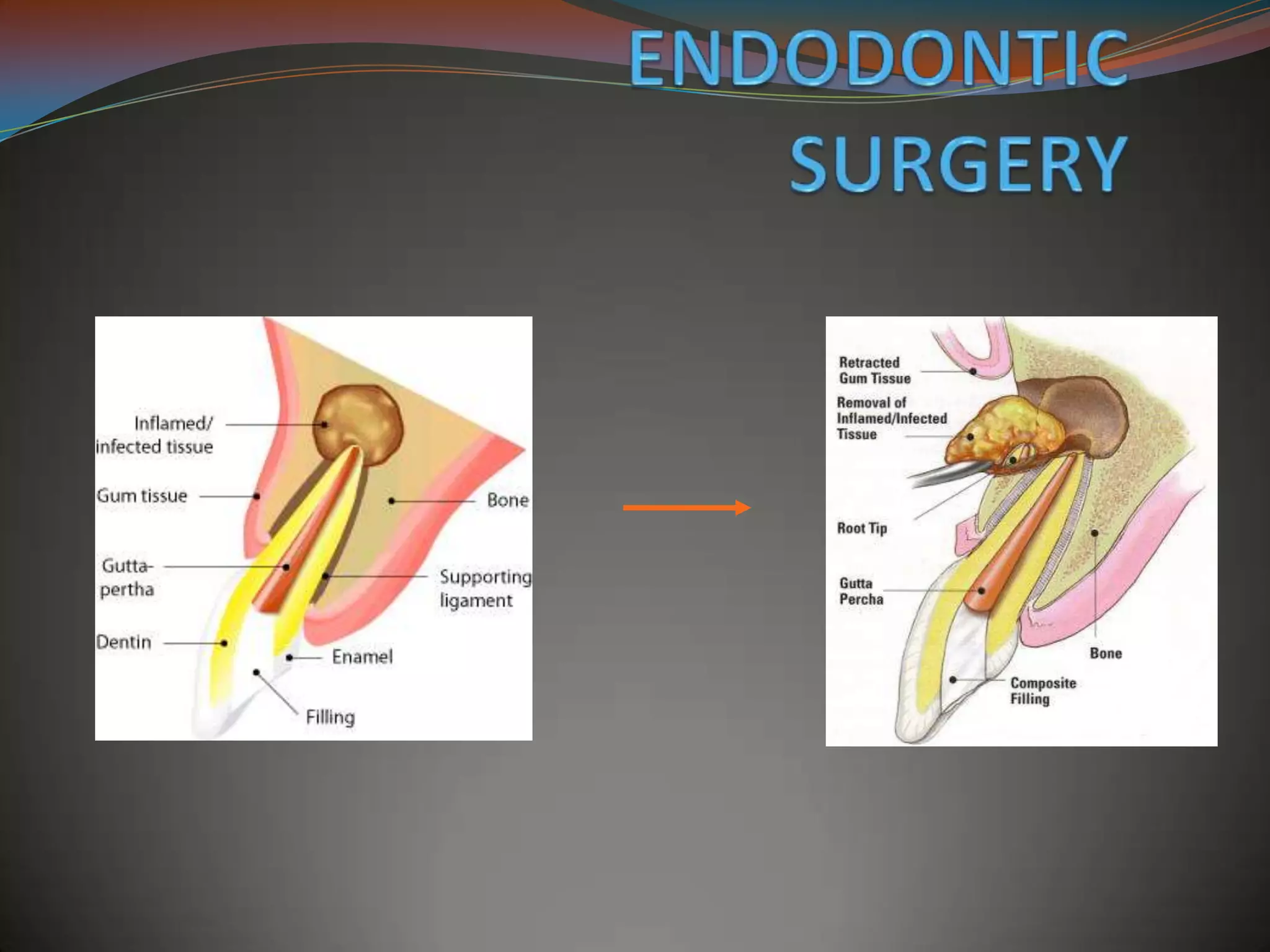 Endodontic surgery | PPTX
