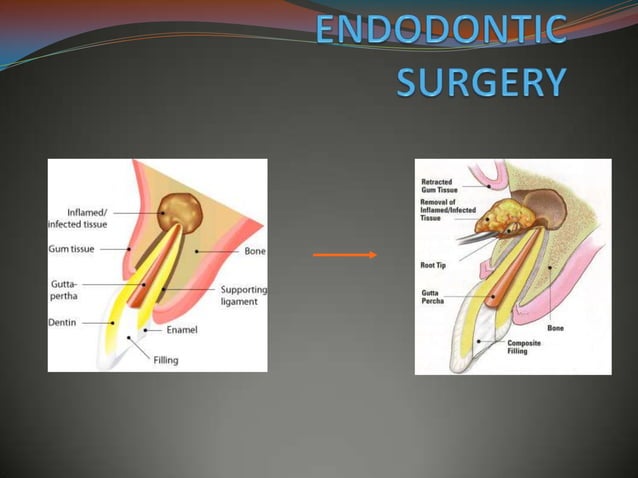 Endodontic surgery | PPTX | Dental Health | Diseases and Conditions