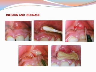 Incision And Drainage Dental