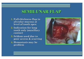Endodontic surgery | PDF