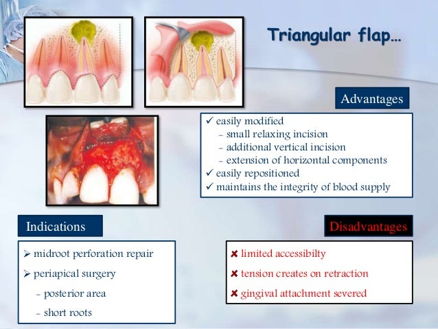 Endodontic surgery