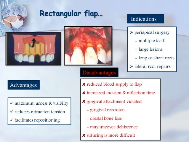Endodontic surgery