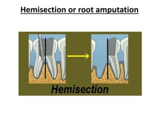 Endodontic surgery | PPTX