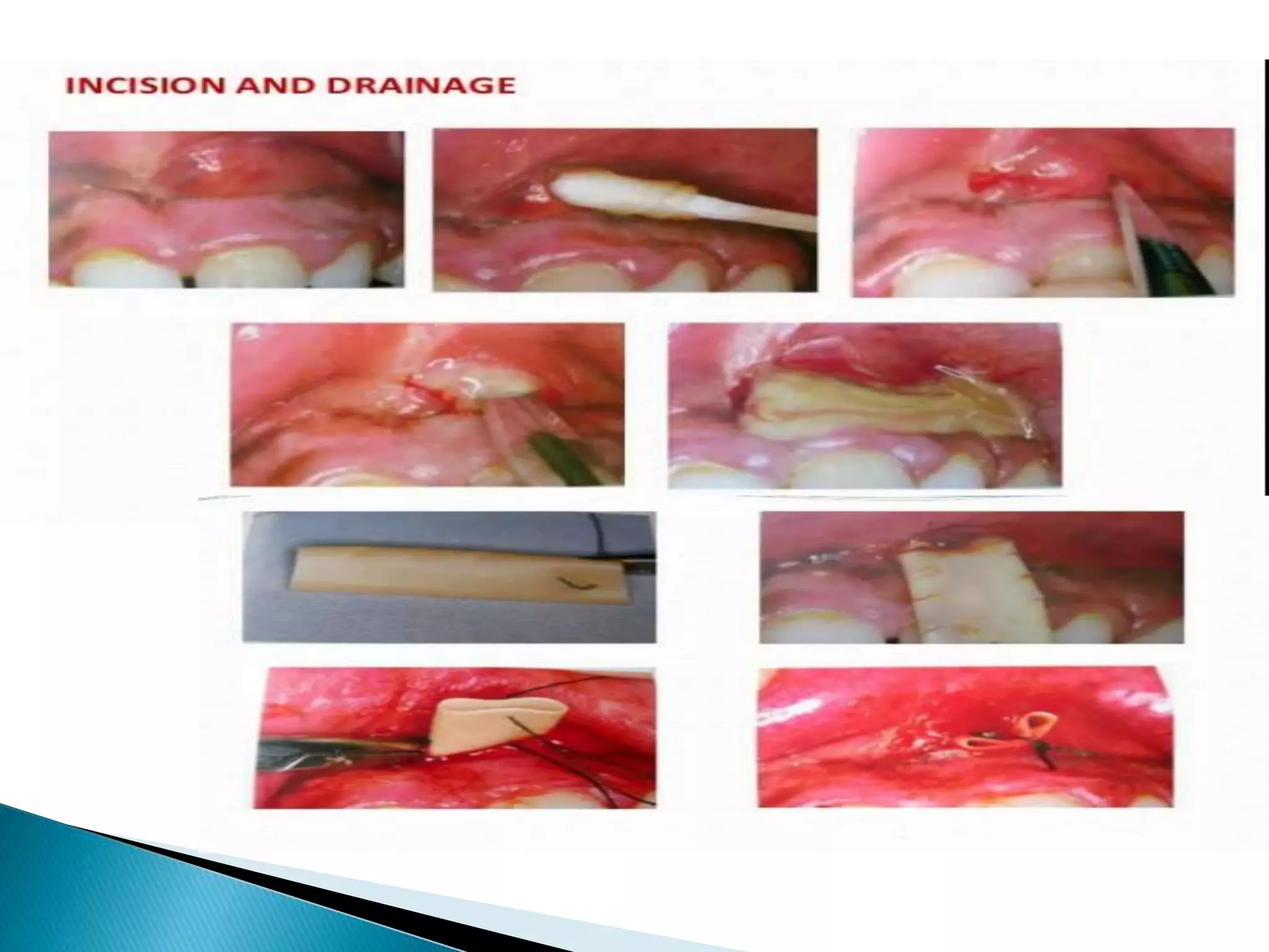 Endodontic surgery.pptx