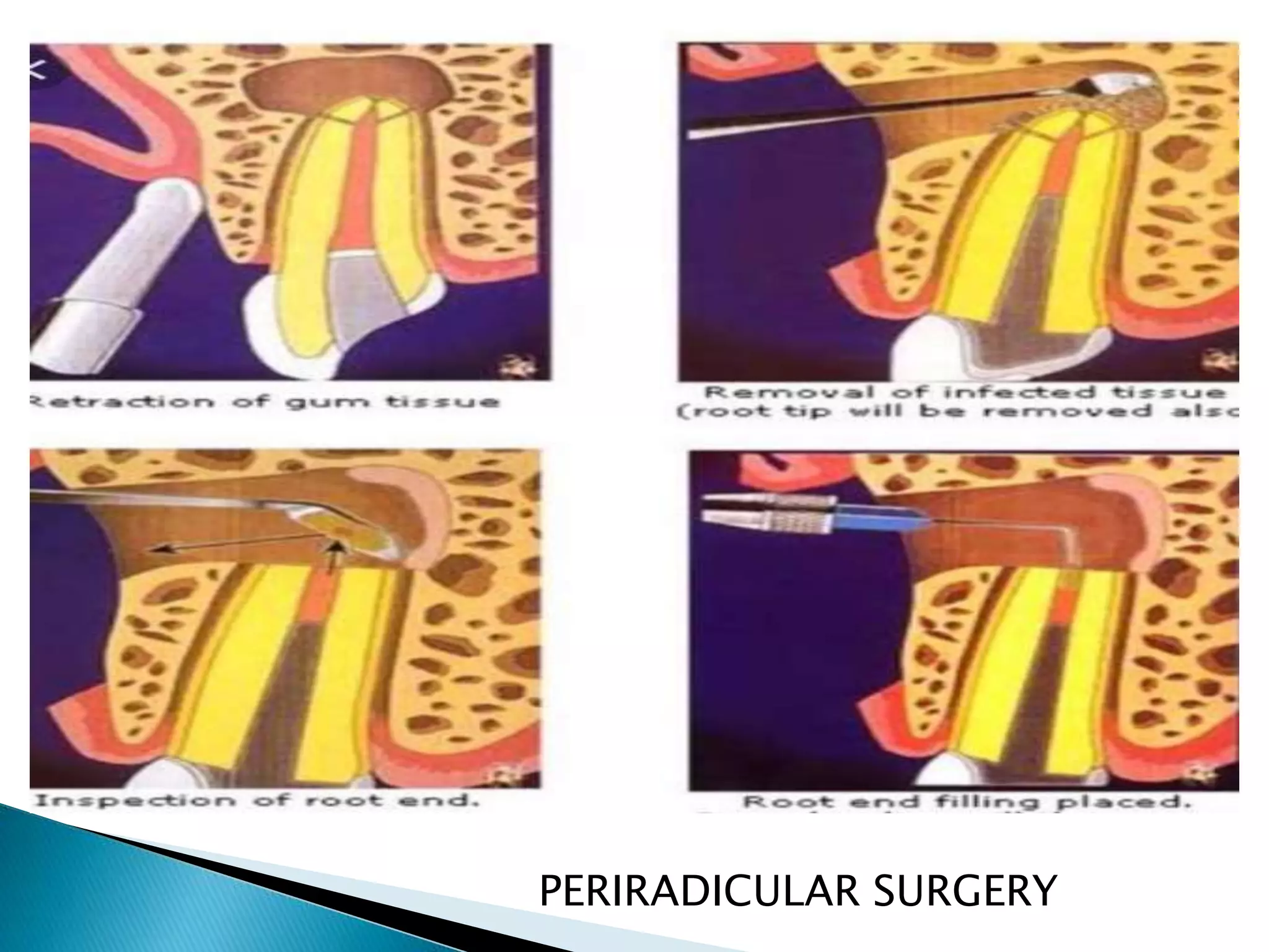Endodontic surgery.pptx