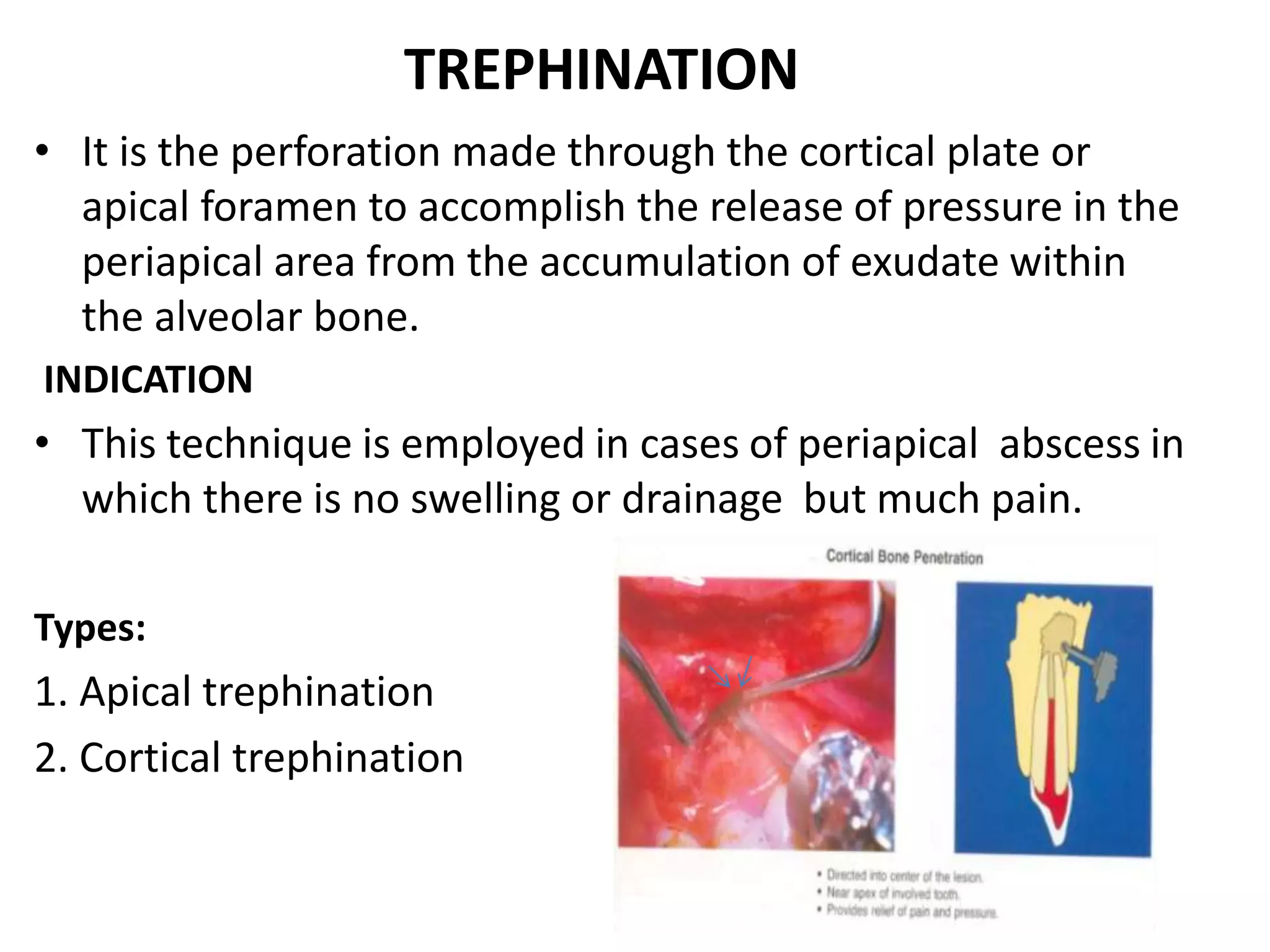 Endodontic surgery (1) (1) | PPTX