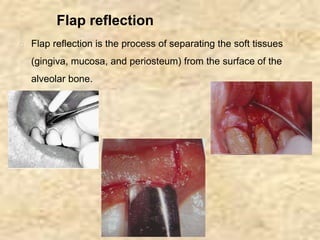 Basic principles of Endodontic Surgery . | PPTX