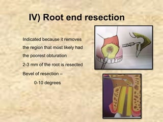 Basic principles of Endodontic Surgery . | PPTX