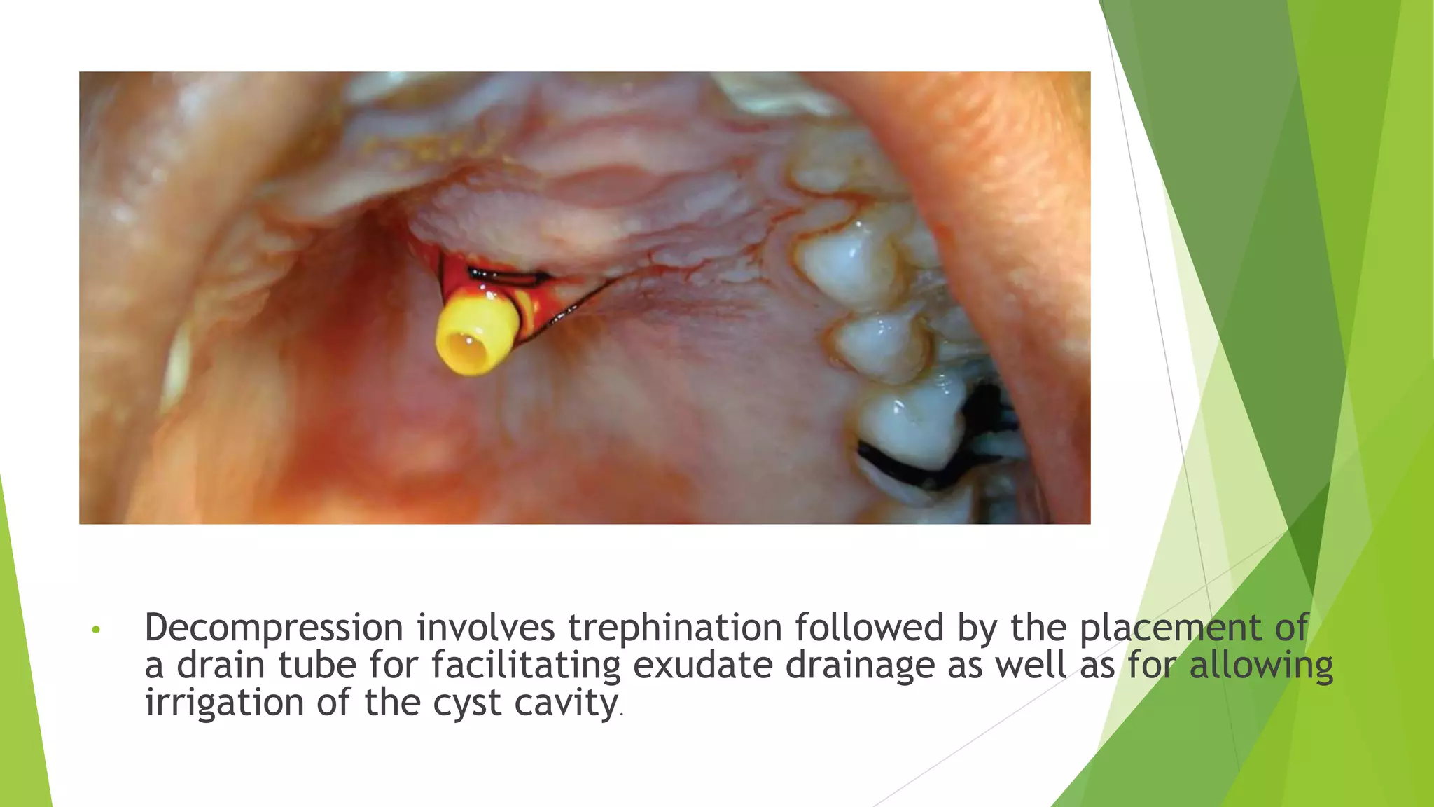 Endodontic treatment of an abscessed tooth | PPT