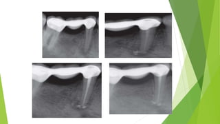 Endodontic treatment of an abscessed tooth | PPT