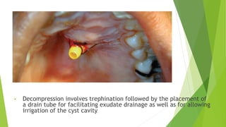 Endodontic treatment of an abscessed tooth | PPT