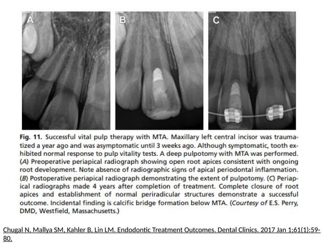 ENDODONTIC TREATMENT OUTCOMES-root canal therapy | PPTX